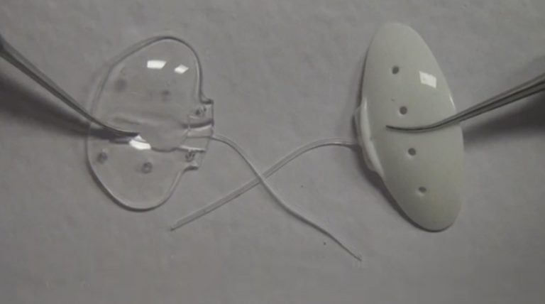 Paul Glaucoma Implant: Updated Surgical Technique